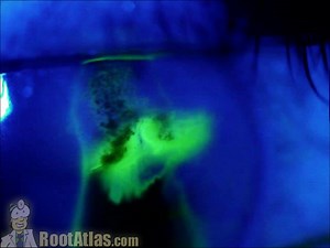Corneal laceration that's seidel positive (Video) - TimRoot.com