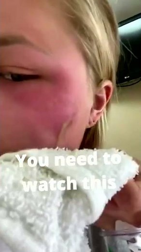 Cystic acne and blackheads removal - Newest pimple pops for 2022