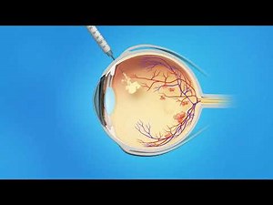 Retina Diabetic Injection Macular Edema