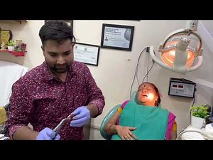 3rd Molar Extraction Full Procedure #extraction #impaction #3rdmolarextractio