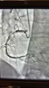Intravascular Lithotripsy IVL in a heavily calcified RCA!