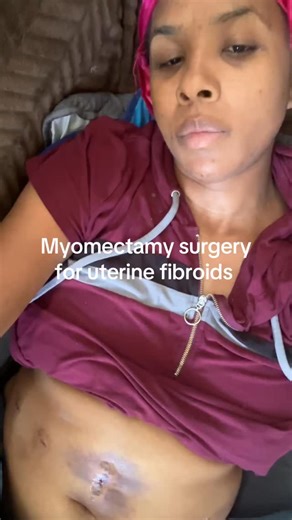 There is an update. Got my myomectomy surgery Monday. Today is Wednesday. I’m still in a lot of pain. My stomach is swollen. It hurts to move, etc. But my fibroids were extremely large on my uterus. And led to infertility issues and struggles with pain for a long time so I’m being open about this in hopes to help other women out there. | AJ Walker News