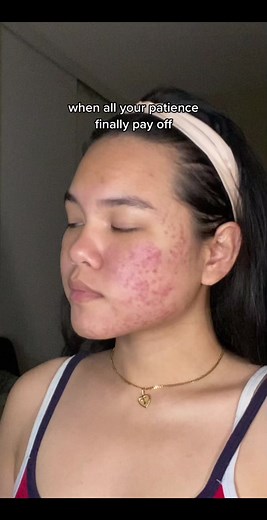 same skincare routine 6 months later!! I know a lot of people hate on proactiv, but their products did wonders for my acne (not sponsored) #acneprogress
