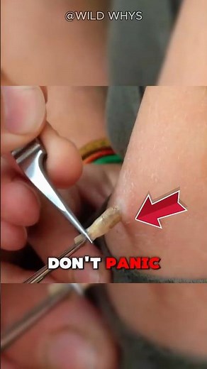 Here's You Gonna Do If Botfly Under Your Skin! 😱