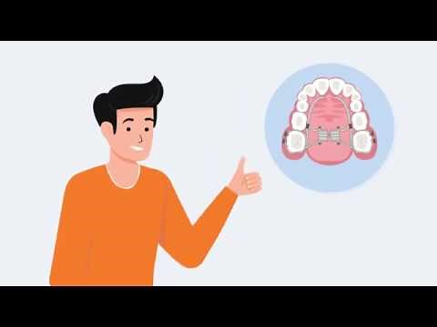 MARPE instruction; what you need to know for MARPE; MSE (maxillary skeletal expander)