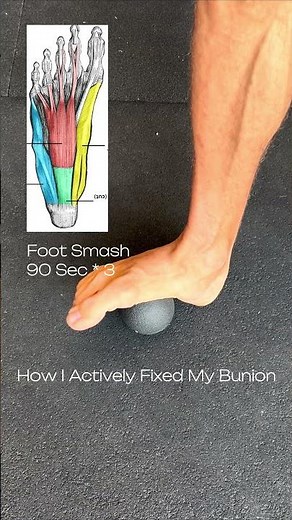 How I Actively Fixed My Bunion