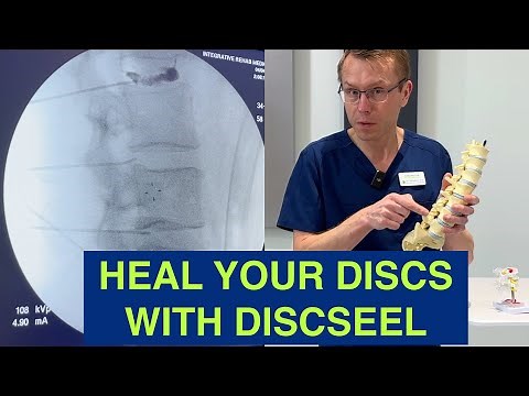 Back Pain Treatment of Damaged Lumbar Discs with Discseel - The Alternative to Spine Surgery