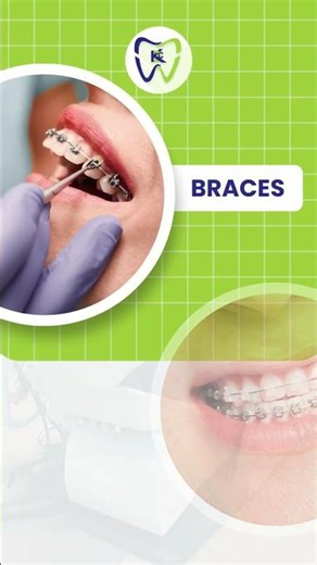 Clear Aligners vs Metal Braces | Smile Transformation Before & After #trending