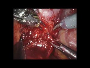 Robotic Radical Prostatectomy - Lateral Approach • Video • MEDtube.net