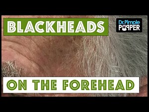 Blackhead Extractions on my lovely patient