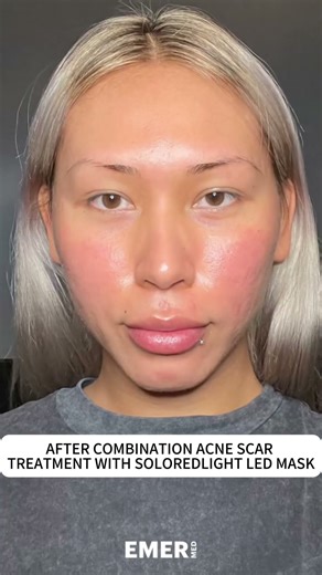 The LED light therapy mask exceeded all my expectations for home care.