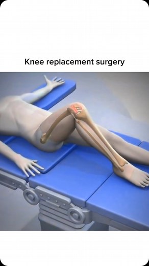 Animations | Follow @surgicalanimation for more! 💊 | Instagram