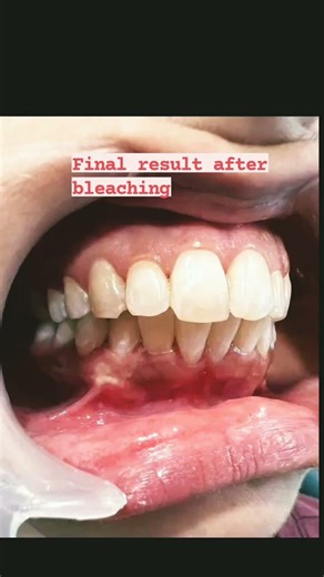 Teeth Whitening & Bleaching Explained | Safe or Not? | Dentist in Chandkheda