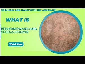 EPIDERMODYSPLASIA VERRUCIFORMIS(EDV) BY DR ABRAHAM #dermatology #HIV #skincondition #lecture