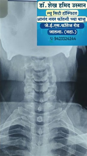 cervical disc herniation treatment #‪@dr.shaikhhamidjalna‬