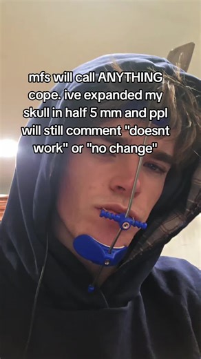 keep coping please #bwython #marpe #lm #psl #airwayorthodontics | marpe