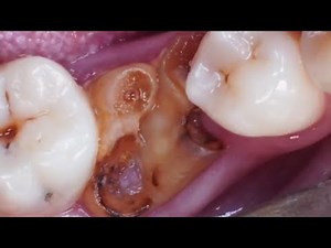 The teeth of high school students are so rotten that only the roots remain. #remove