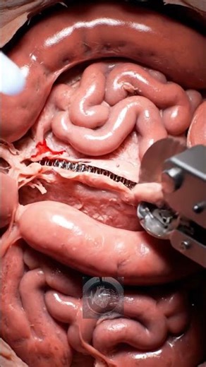 Laparoscopic Bowel Resection With Stapler Use | Minimally-Invasive Surgical Technique Explained