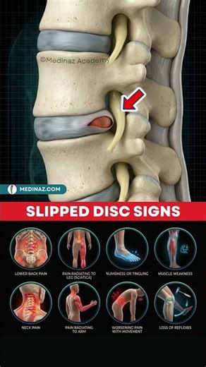 Slipped Disc Symptoms You Should NEVER Ignore | Slipped Disc Signs