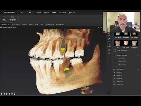 DTX Studio Implant Functionality Introduction