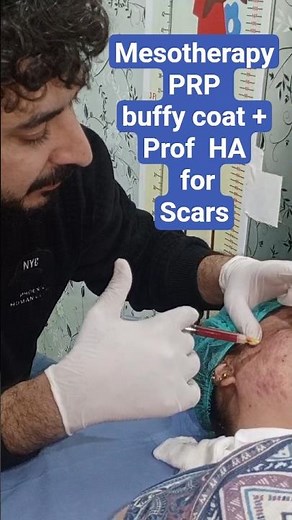 Acne Scars treatment | Mesotherapy for scars | PRP buffy coat | Best scars treatment