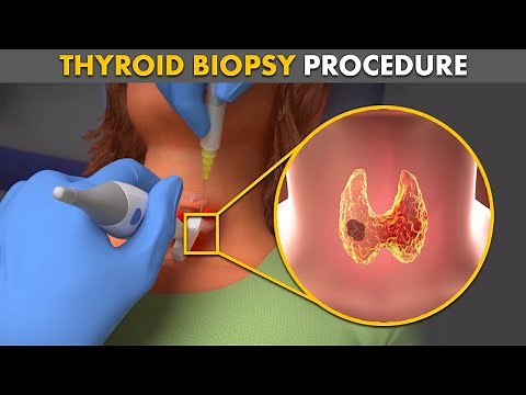 How Thyroid Biopsy procedure is performed?
