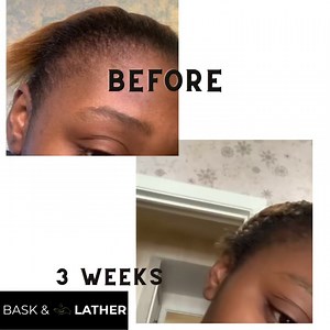 3 Week Update ‼️ Our Scalp Stimulator works wonders to regrow edges🙌🏽💛 Look at how much her edges have grown. Tip: Rub a small amount of Elixir on to your edges after using the Stimulator to achieve fullness even faster. . . . . . . . #hairlosssolutions #hairlosssolution #hairgrowthproducts #longhairdocare #naturalhairproducts #naturalhairproblems #NaturalHair #HairGrowth #Alopecia #HairOils #Hairgrowthoils #HairRetention #hairgrowth #hair #haircare #healthyhair #hairgoals #hairloss #4chairgr
