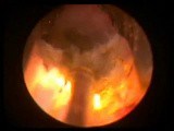 Greenlight Vaporization - Urethral Strictures • Video • MEDtube.net