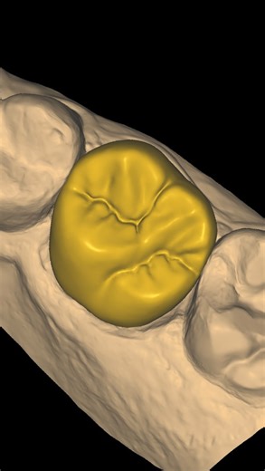 Vlad Panov on Instagram: "Моделирование 26-го зуба в ExoCad🫠 (Не обязывает Вас делать так-же😇)"