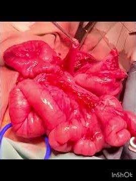 A Modification for Cloacal Exstrophy Repair :Leaving the Cecal Plate Untouched