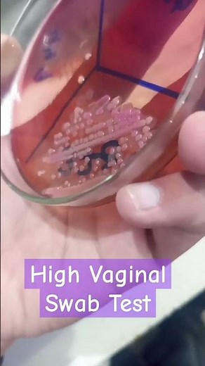 high vaginal swab (HVS) is a medical procedure performed in obstetrics and gynaecology to test