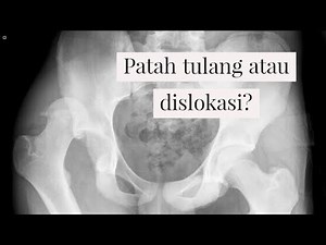 Hip fracture or dislocation, solution options