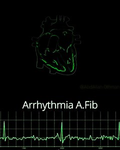 1.8K views · 509 reactions |  AFib Trigger Update: Key Modifiable...