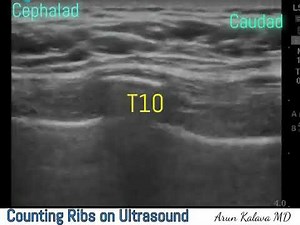 Counting Ribs on Ultrasound