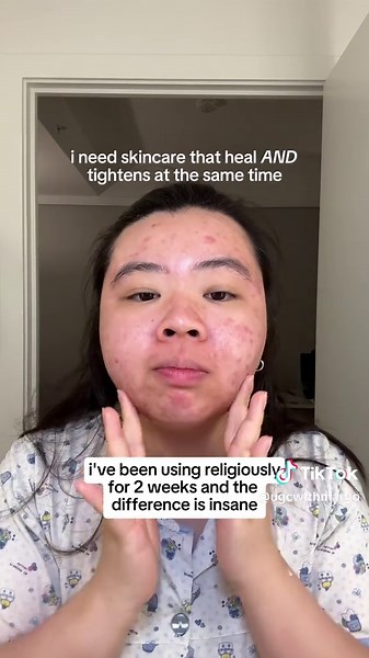 as someone with acne-prone, 25 skin that’s been struggling to bounce back (especially after long-term sleep deprivation and a carb-heavy diet lol), this cream is surprisingly powerful. I’ve been using it religiously for 2 weeks and the lifting healing effect is REALLLL. It’s thick and rich but not greasy, and honestly feels like a painless, non-invasive and way more affordable version of botox 💉 @BIOHEAL BOH #boh #bioheal #purplebotox #purplebotoxcream #botox #facelifting #nightcream #antiaging