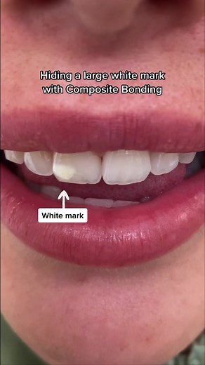 Hiding a large white mark with Composite Bonding