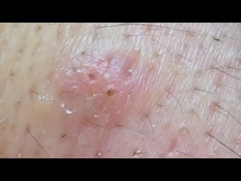 Popping My Own Pimples | Sebum Squeeze & Self-Extraction #60 #sebum #acne #pimple #pimplepopping