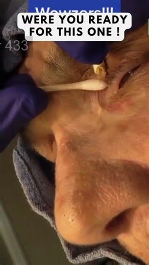 Removing large blackheads and pimples from face new 2026 #151