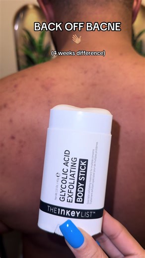 Effective Solutions for Acne Scars and Bacne