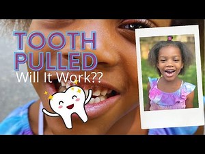 Pulling 1st tooth out Attempt