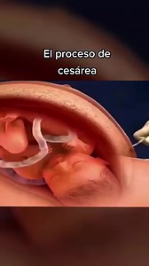 Cesárea paso a paso https://www.serpadres.es/parto/13772.html | Ser Padres España
