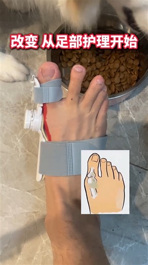 A Bunion Splint Demo #bunion splint #bunion corrector #foot pain relief #youtubeshorts
