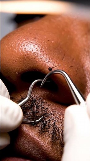 Nose Filament Extraction 👃✨ So Satisfying! #skincare #nosereshape #animation #satisfying #funny