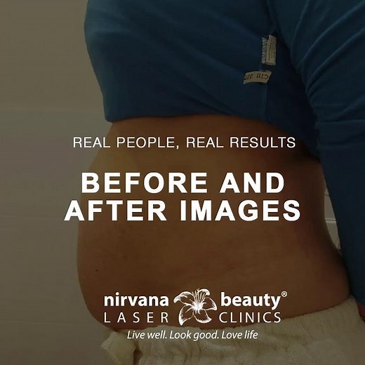 Non-surgical Liposuction Before and After