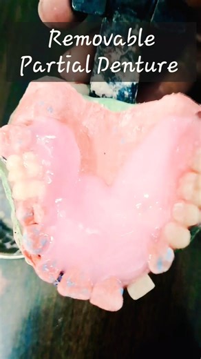 Removable Partial Denture🦷 #dentallab #dentistry #dentalclinic #smiledesign