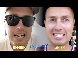 Invisalign Review | Invisalign Before And After
