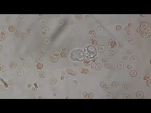 Pleural fluid under the microscope showing Pus cells, RBCs, and Mesothelial cells
