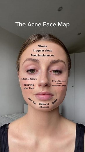 Decoding Your Breakouts: Understanding the Acne Face Map