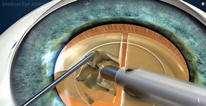 Cataract Surgery at Medical Eye Associates - Medical Eye Associates