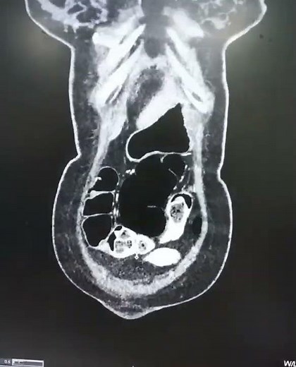 Dolichocolon(aka redundant colon) ctscan findings/Radiology